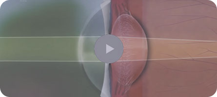 Crosslinking en Monterrey | Dr. Enrique Barragán